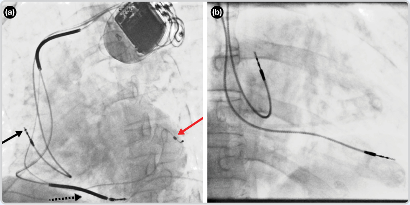 Detecting and Distinguishing Cardiac Pacing Artifacts | Analog Devices